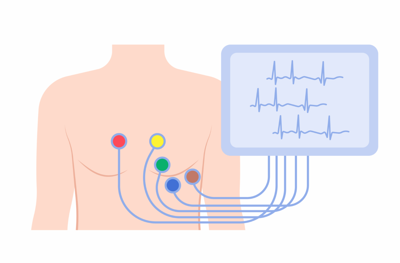 HOLTER 24 HORAS: para que serve, como funciona, resultados - Blog Saude Trevo