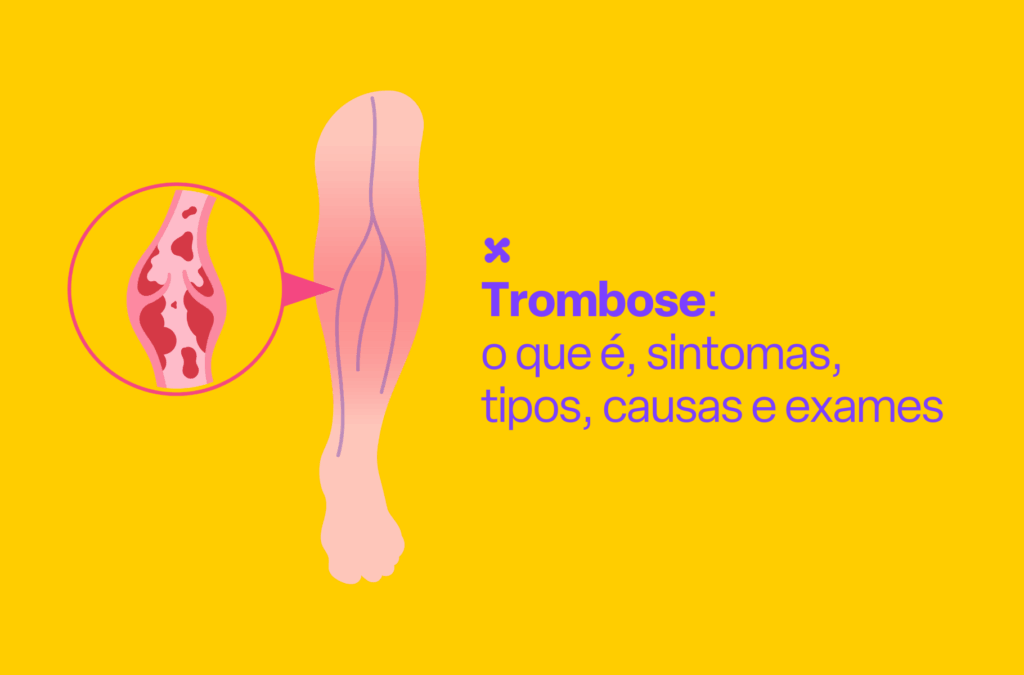 Trombose: o que é, sintomas, tipos, causas e exames - Blog Saude Trevo